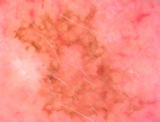 Dermatoscopie van een lentigo benigna - Dermatoscopie.nl